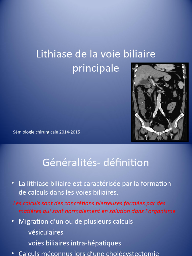 Lithiase de la voie biliaire principale | PDF