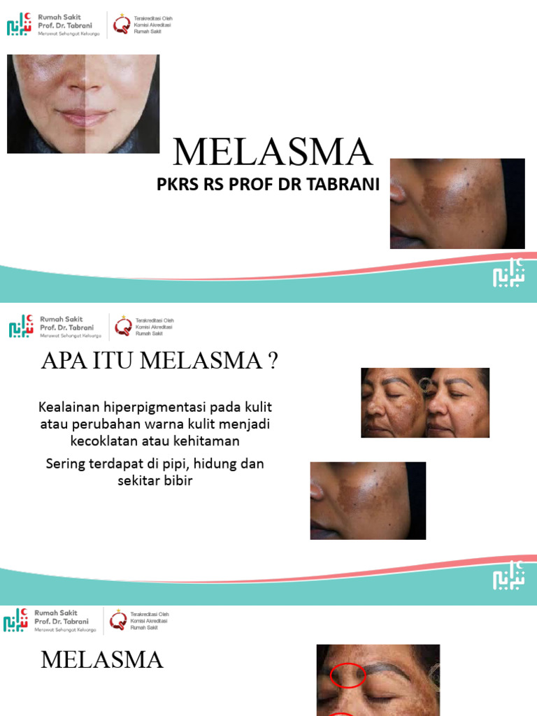 MELASMA | PDF