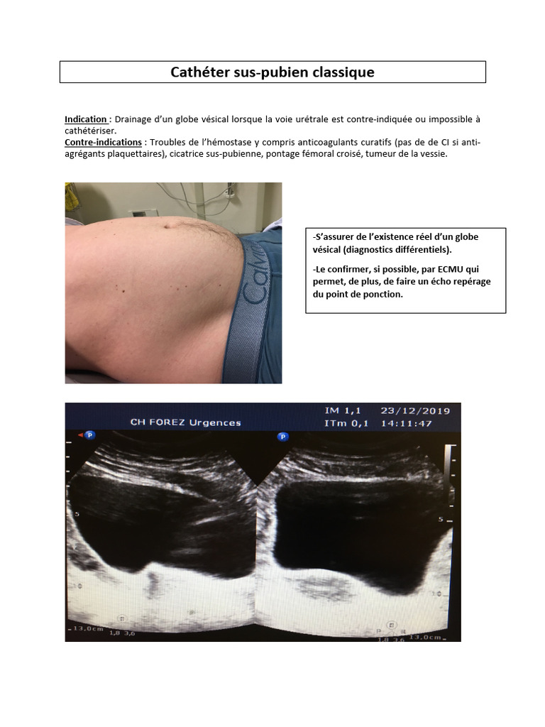 202001 Cathéter Sus-pubien | PDF