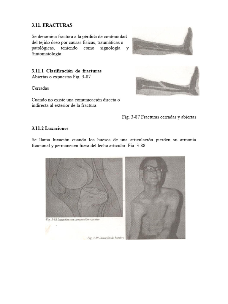 Fracturas | PDF | Hueso | Enfermedades y trastornos humanos