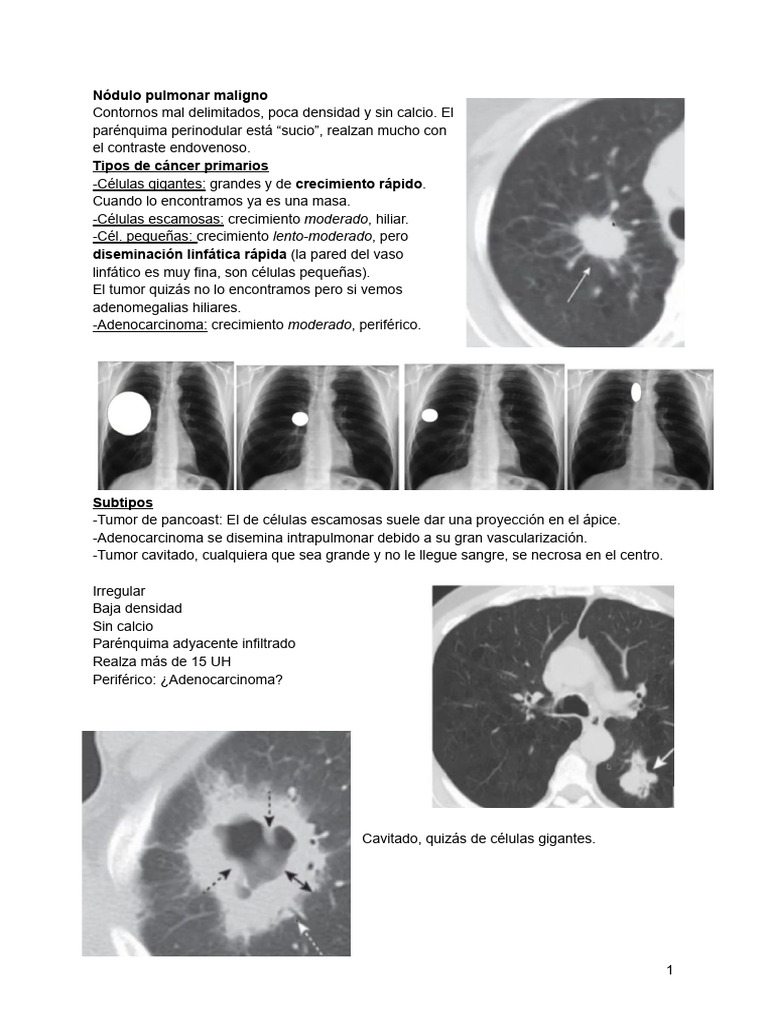 Nódulo Pulmonar Maligno - Diagnostico Por Imágenes | PDF | Cáncer | Medicina CLINICA