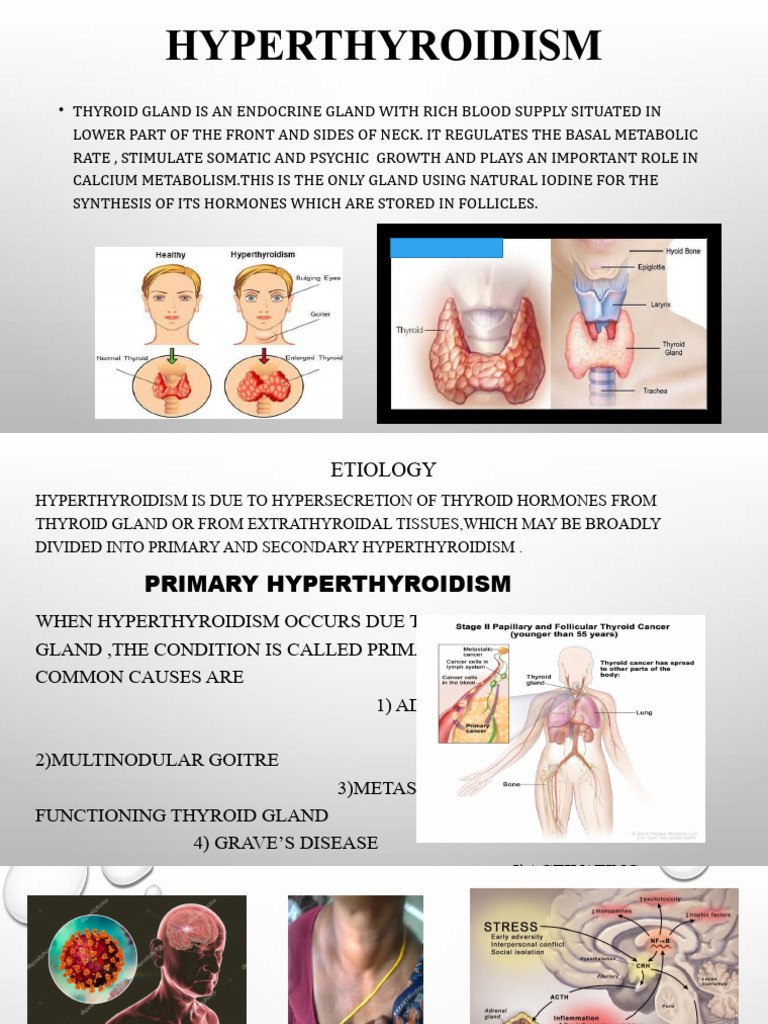 Hyperthyroid Is M | PDF