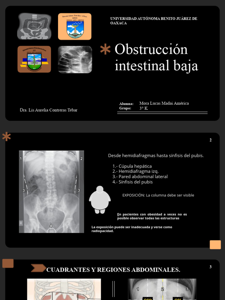 Obstrucción Intestinal Baja: Diagnóstico y Causas | PDF | Intestino ...