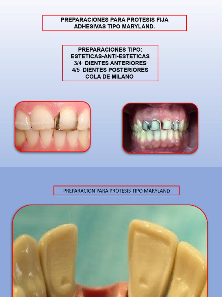 3.- Teoria - Preparacion Adhesivas Maryland | PDF