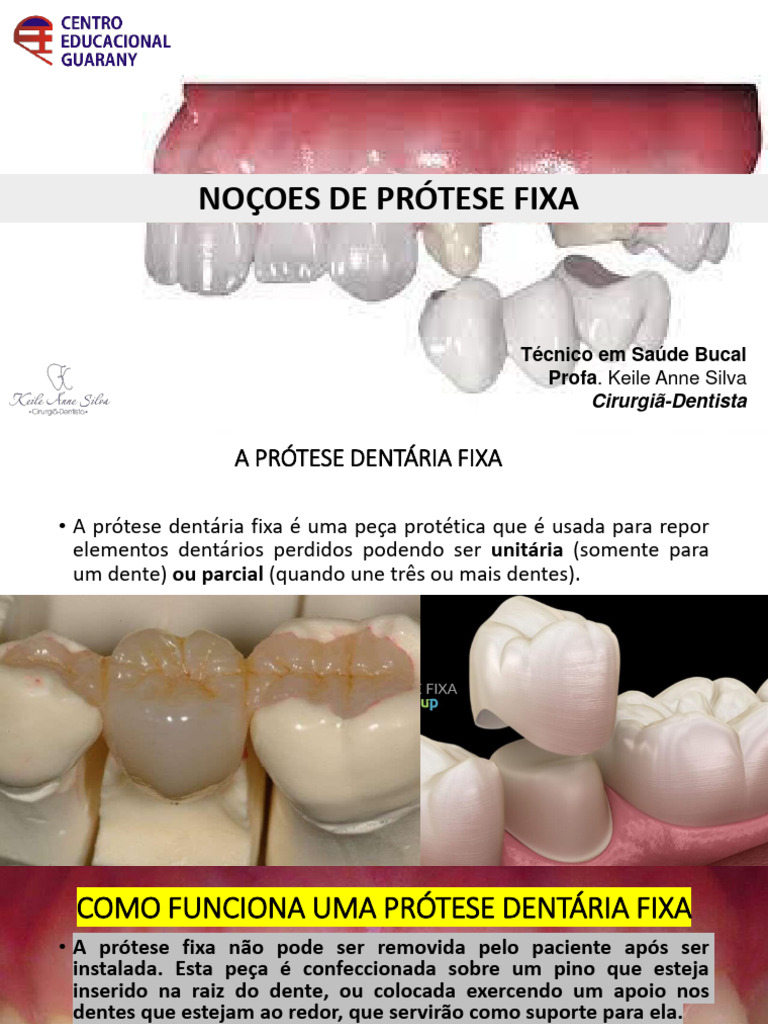 Noções de Prótese Fixa | PDF | Dente humano | Prótese