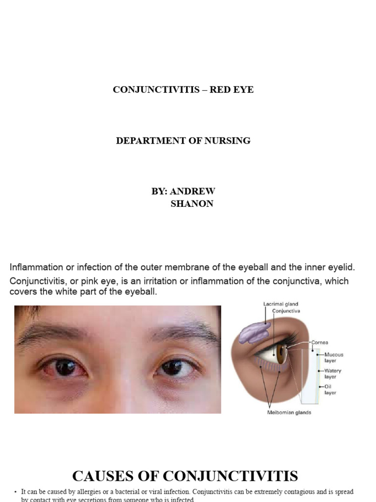 CONJUNCTIVITIS | PDF | Medical Specialties | Clinical Medicine