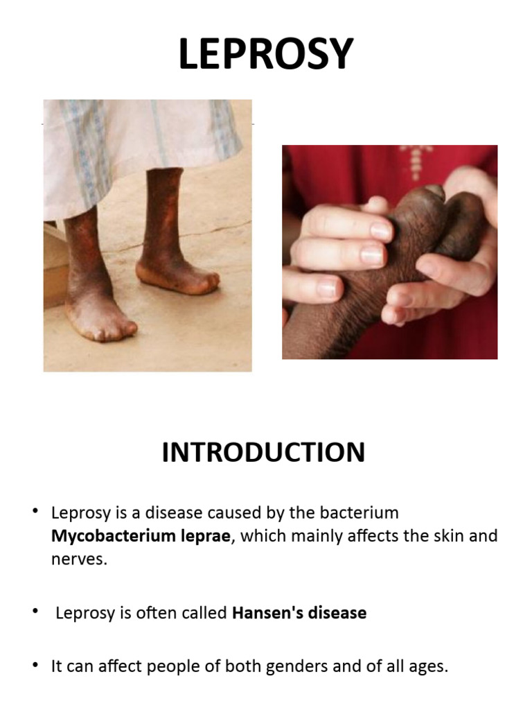 LEPROSY | PDF | Leprosy | Thumb