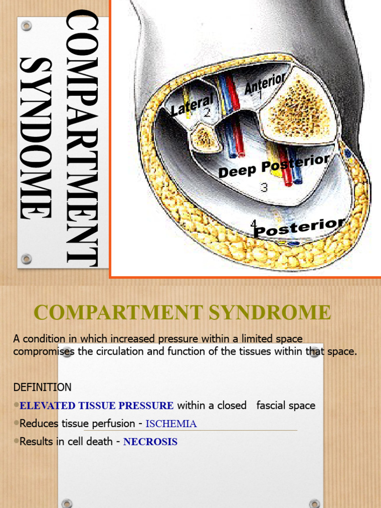 Compartment Syndrome | PDF | Human Leg | Clinical Medicine