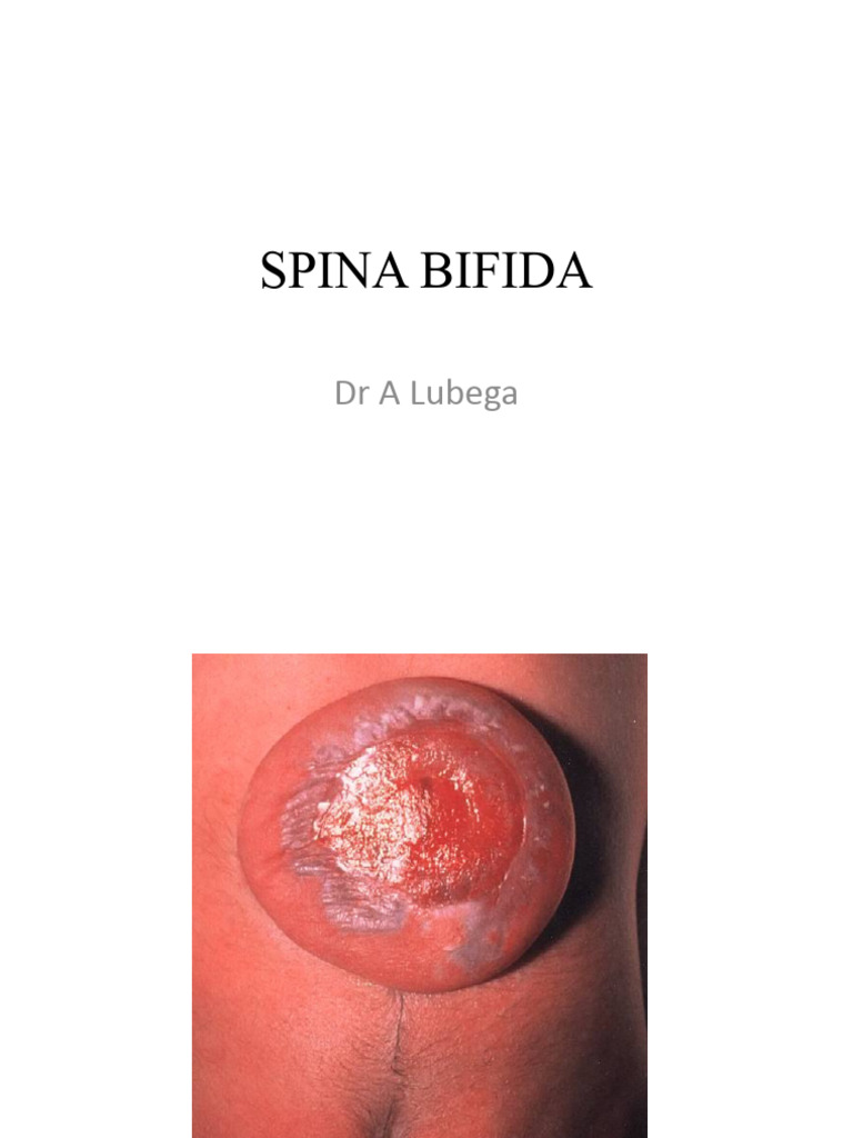 Spina Bifida | PDF | Vertebral Column | Spinal Cord