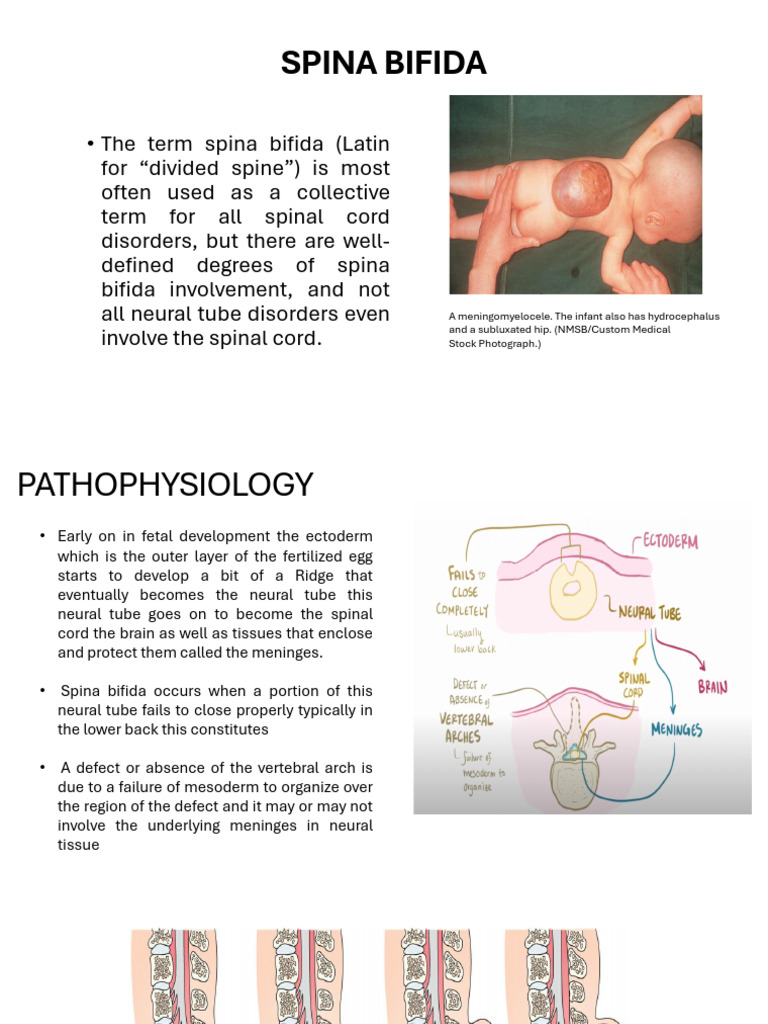 Spina Bifida | PDF | Vertebral Column | Causes Of Death