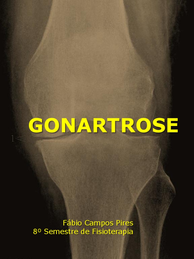 Gonartrose: Causas, Sintomas e Tratamentos | PDF | Osteoartrite | Remédio