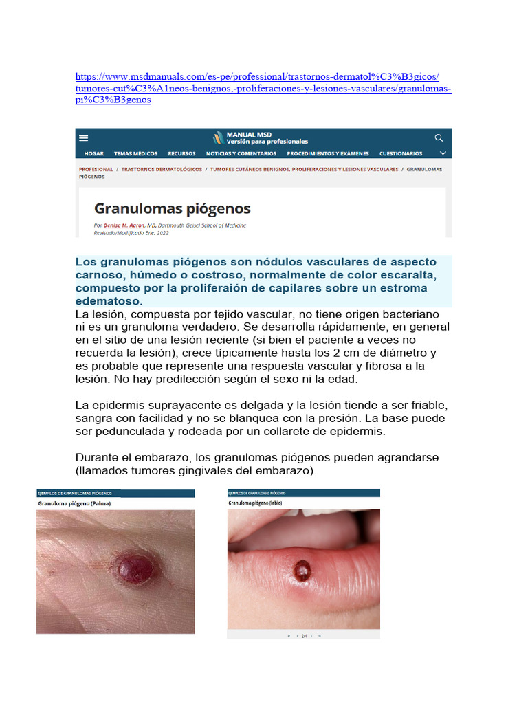 Granuloma Piógeno Presentación Inusual En Embarazo – OVFRQ