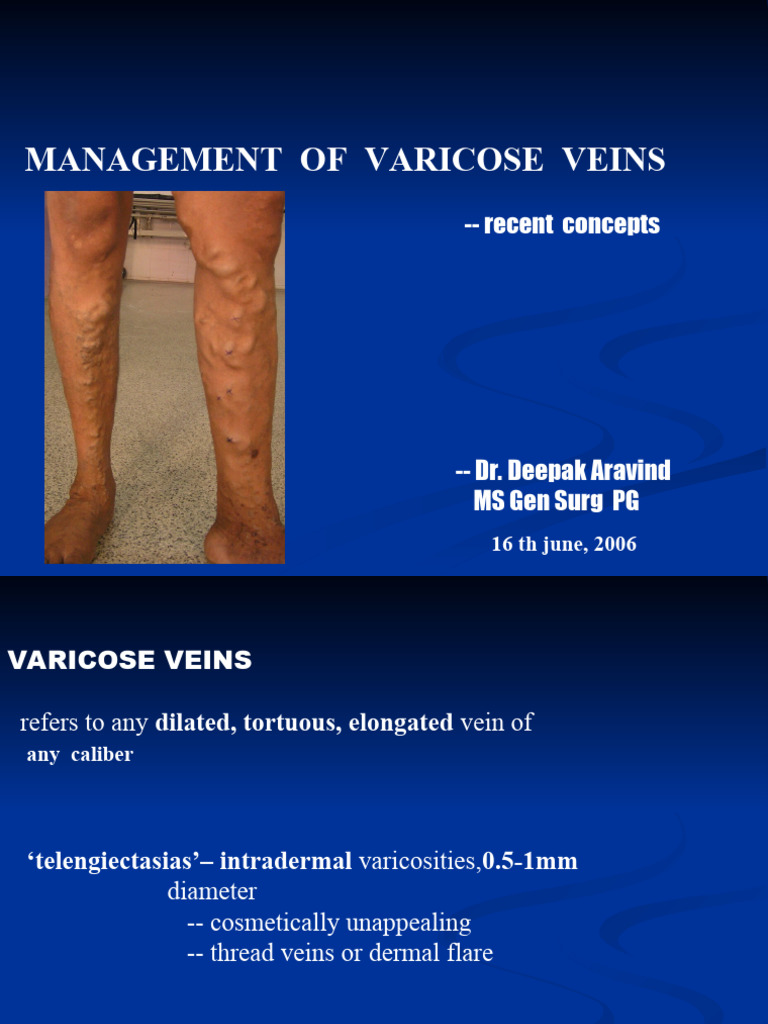 Varicose Vein Mx | PDF | Vein | Varicose Veins