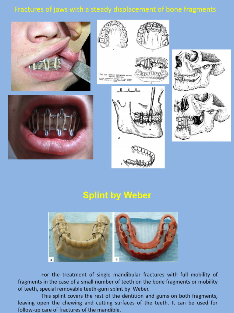 Laboratory splints | PDF | Prosthodontics | Tooth