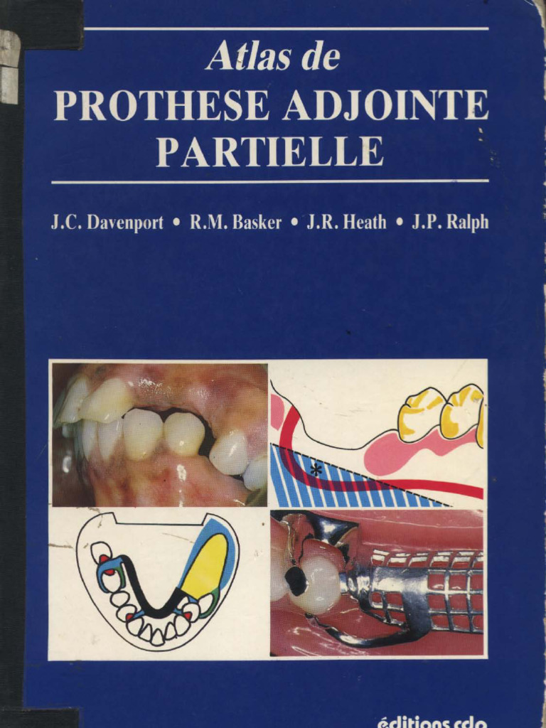 Atlas de Prothese Adjointe Partielle | PDF