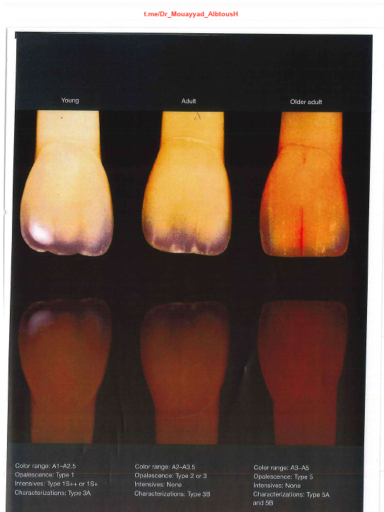 Restoring Young Teeth: Layering Techniques | PDF | Tooth Enamel | Dentin