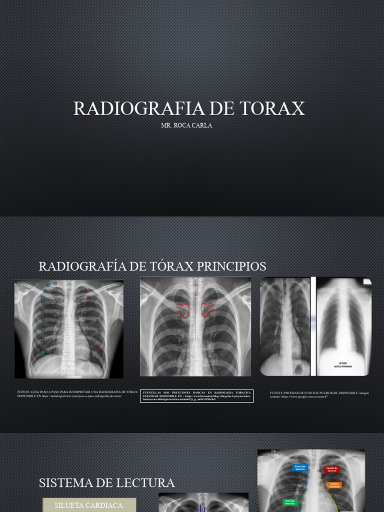 Radiografia de Torax | PDF | Medicina CLINICA | Especialidades Medicas