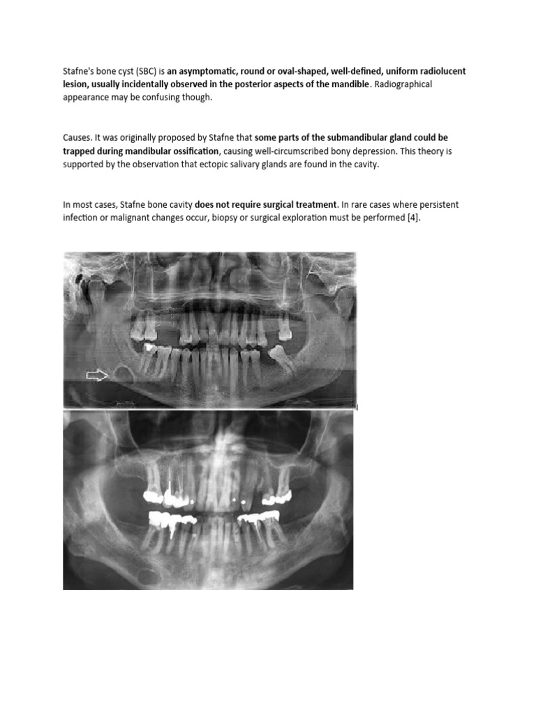 Stafne's Bone Cyst (SBC) | PDF | Diseases And Disorders | Clinical Medicine