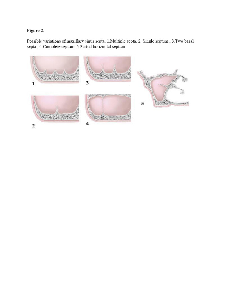 Maxillary Sinus Septa Variations Explained | PDF