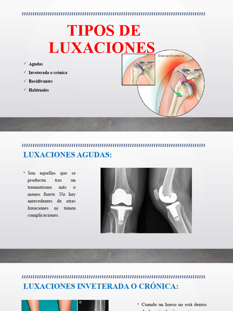 Tipos de Luxaciones | PDF | Rodilla | Articulación