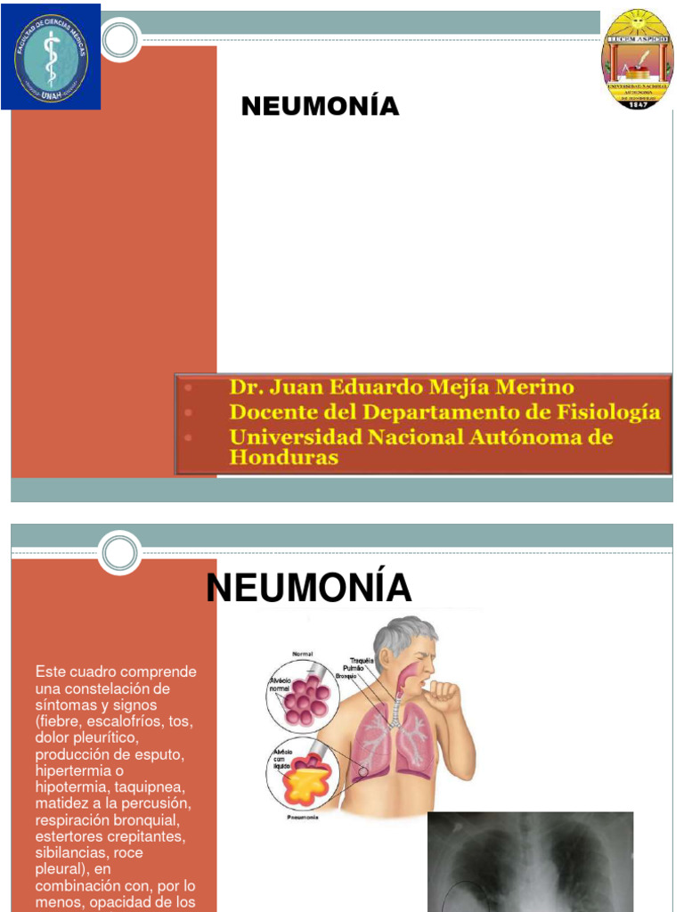 Neumonía | PDF | Neumonía | Sistema inmune