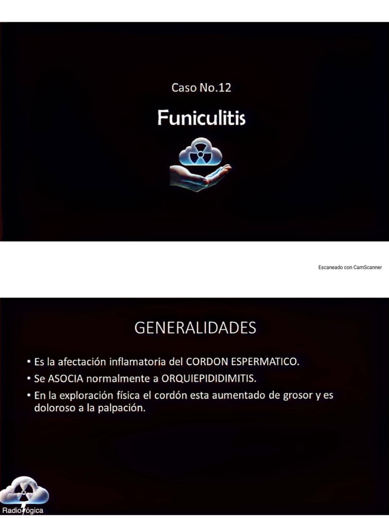 Funiculitis | PDF