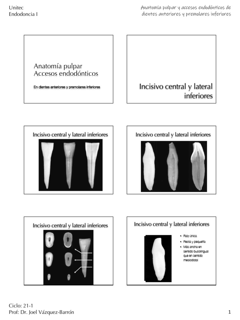 Anatomía pulpar y accesos endodónticos en dientes anteriores y ...