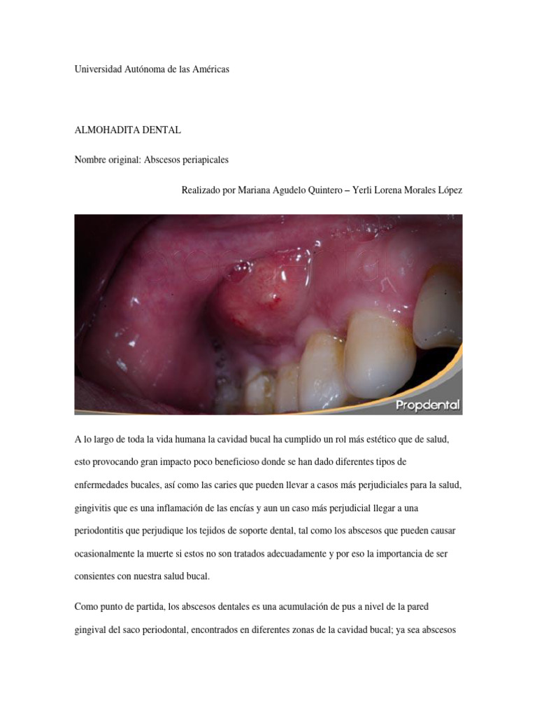 Abscesos Periapicales: Causas y Tratamiento | PDF | Especialidades ...