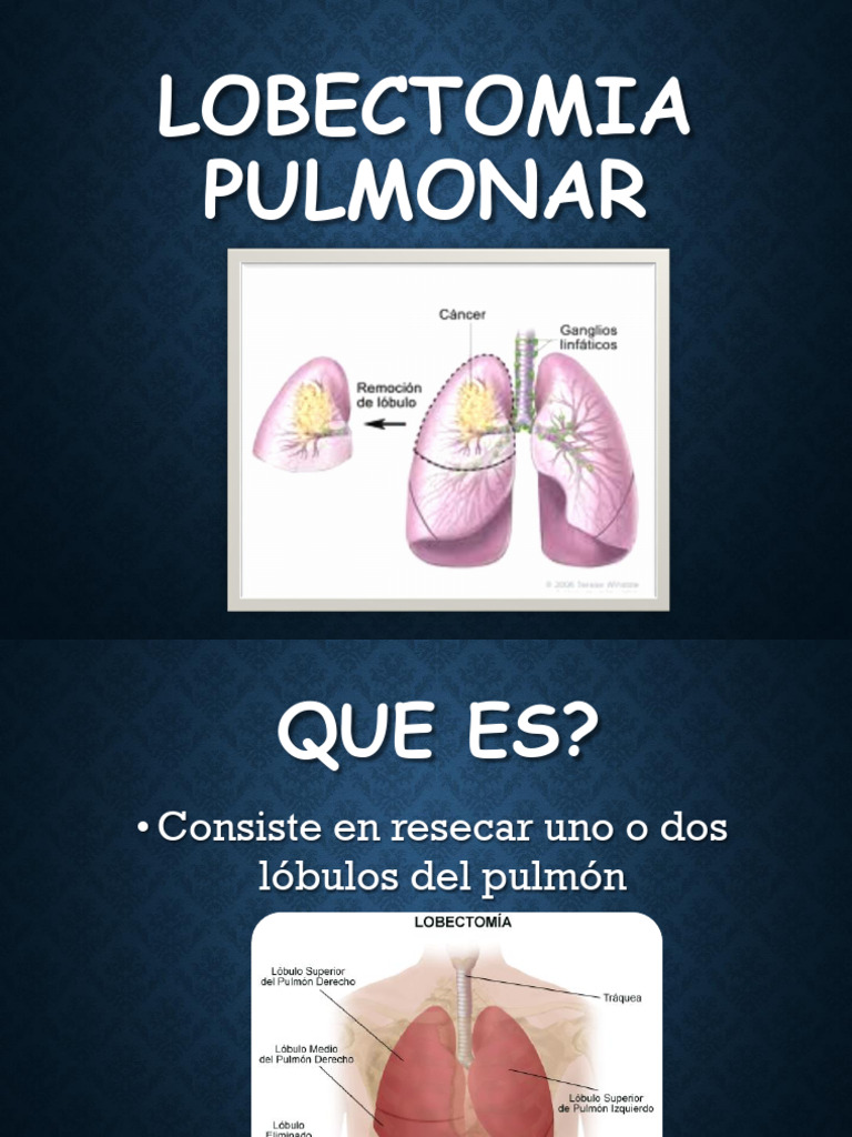 LOBECTOMIA NEUNOMECTOMIA PULMONAR | PDF | Pulmón | Cirugía