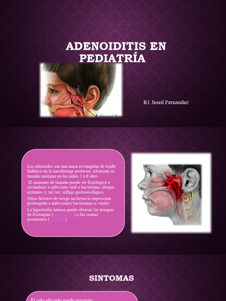 Adenoiditis en Pediatría | PDF