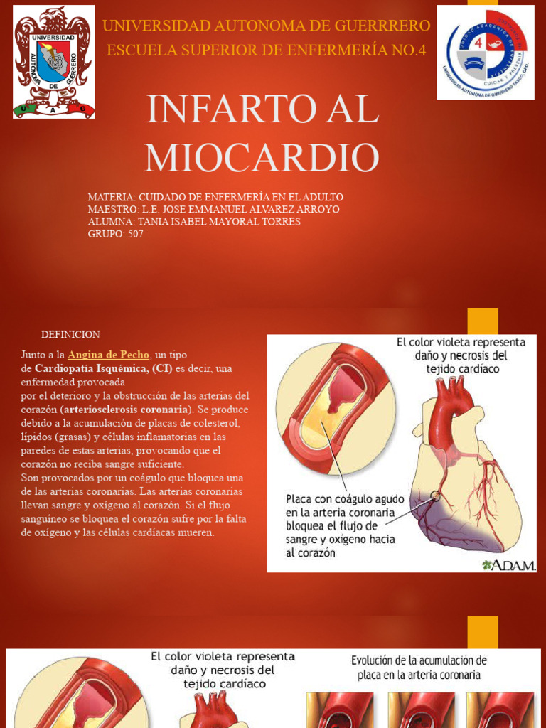 Infarto: Síntomas y Tratamientos | PDF | Infarto de miocardio | Corazón