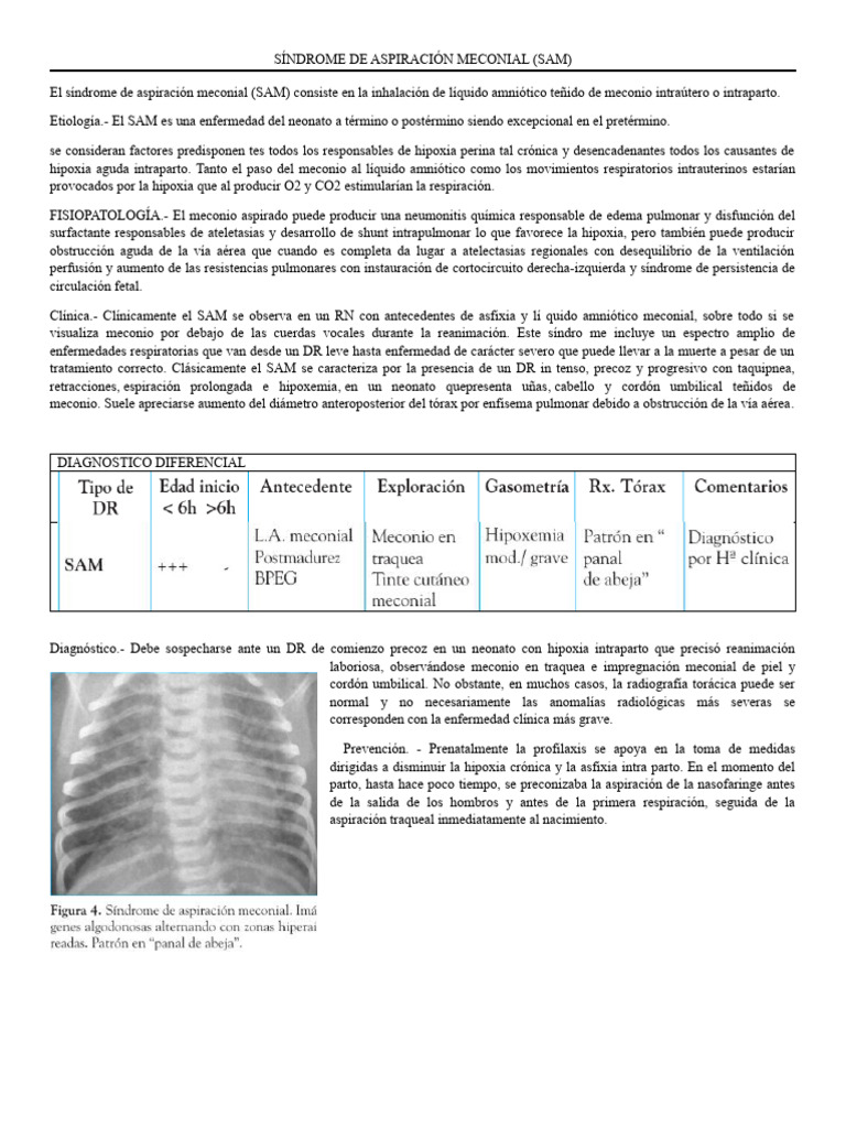 Síndrome de Aspiración Meconial en Neonatos | PDF | Neumología ...