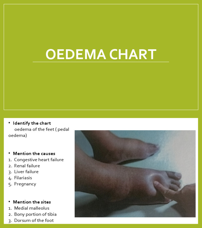 Oedema Chart | PDF