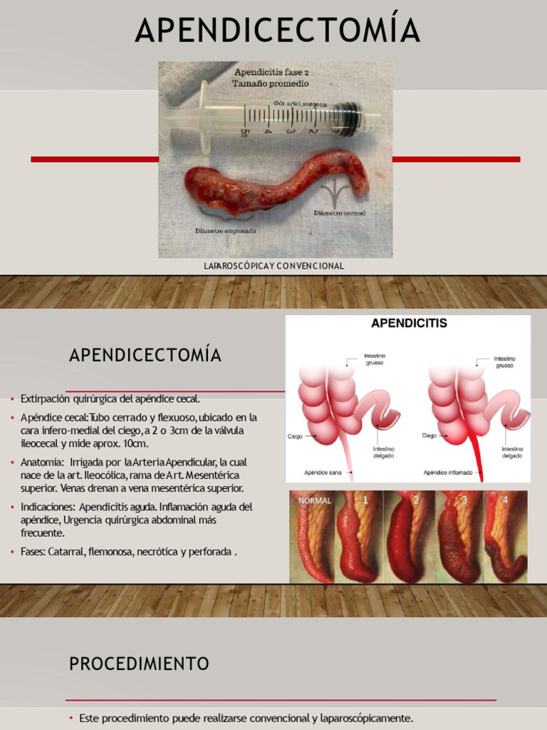 Apendicectomía Laparoscópica y Convencional | PDF | Cirugía | Medicina ...