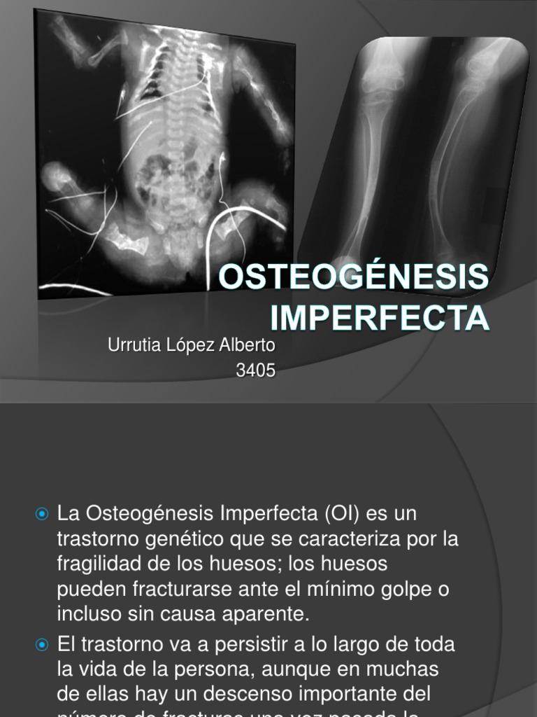 Osteogénesis Imperfecta | PDF | Diagnostico medico | Hueso