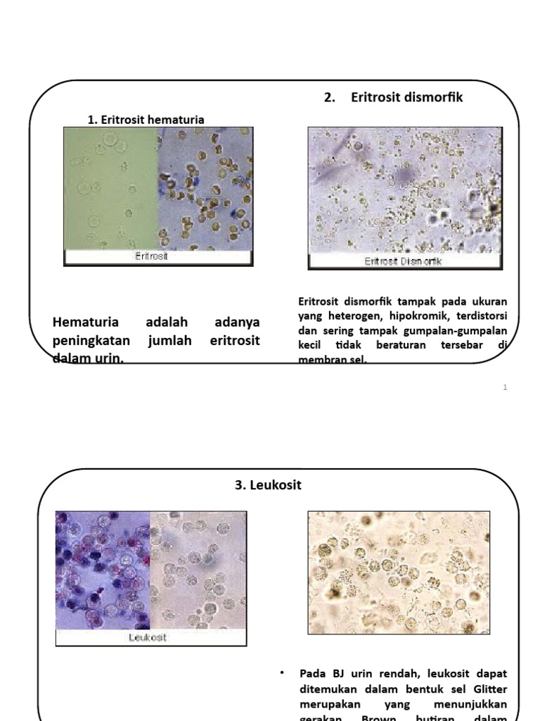 Analisis Sedimen Urin: Eritrosit & Leukosit | PDF
