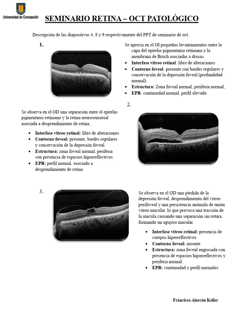 Análisis OCT de Patologías Retinianas | PDF | Sentidos | Órganos ...