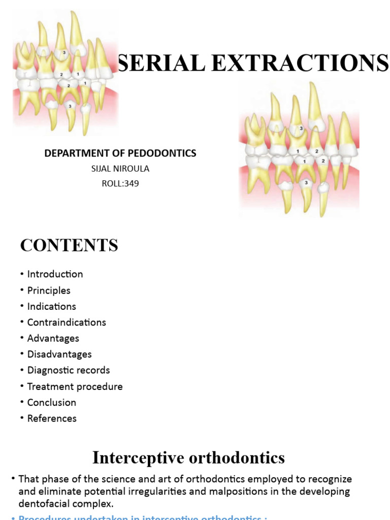 Serial Extractions | PDF | Human Tooth | Dental Anatomy