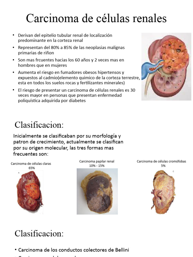 Carcinoma de Células Renales | PDF | Riñón | Biología Celular)