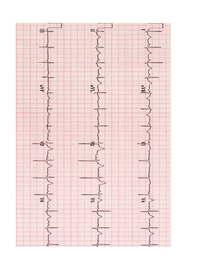 Ekg Pdf