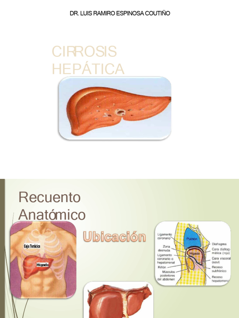 Cirrosis Heptica | Descargar gratis PDF | Cirrosis | Especialidades Medicas