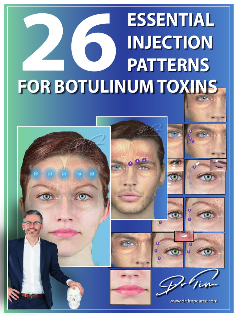 26 Essential Botox Injection Patterns | Download Free PDF | Botulinum ...