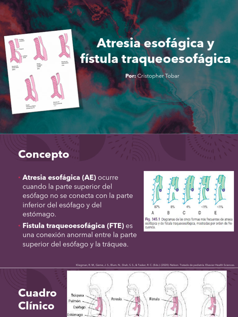 Atresia Esofágica y Fístula: Guía Clínica | PDF | Gastroenterología ...