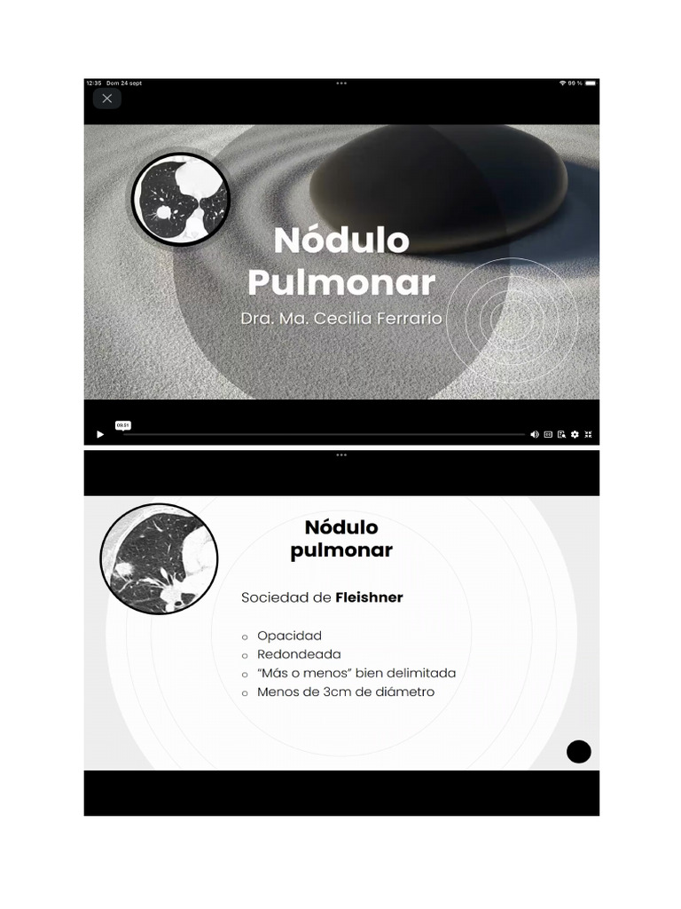 Nódulo Pulmonar | PDF