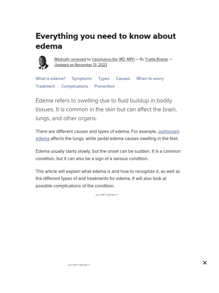Edema - Types, Causes, Symptoms, and Treatment | PDF | Edema | Vein