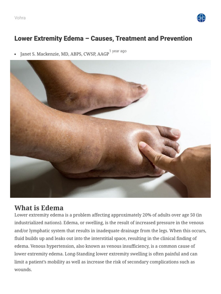 Lower Extremity Edema - Causes, Treatment, and Prevention | Download ...
