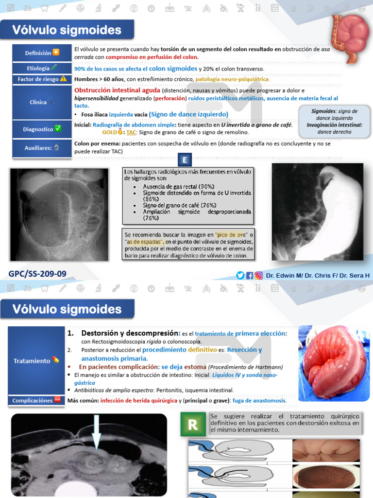 Vólvulo sigmoides | PDF | Intestino grueso | Especialidades Medicas