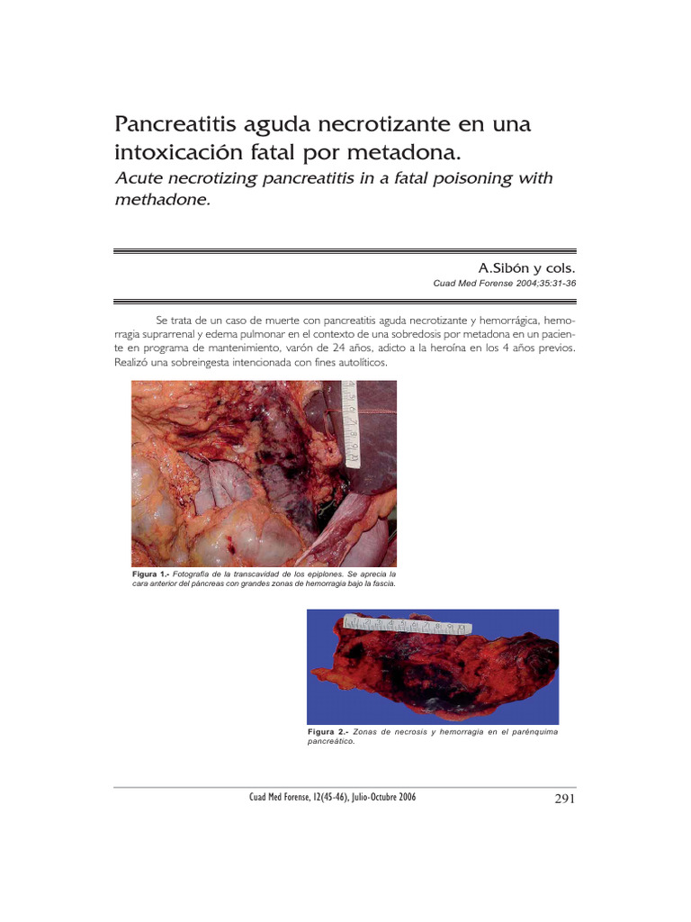 Pancreatitis Aguda Necrotizante en Una Intoxicación Fatal Por Metadona ...