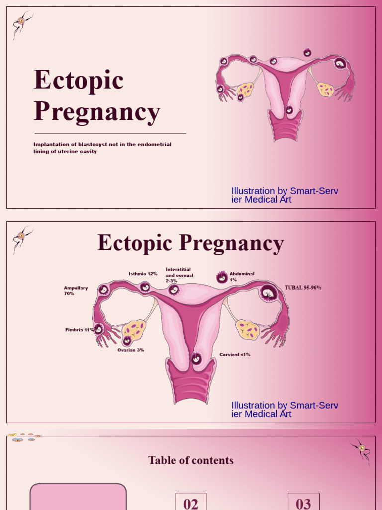 Ectopic Pregnancy Breakthrough by Slidesgo - Read-Only | PDF ...