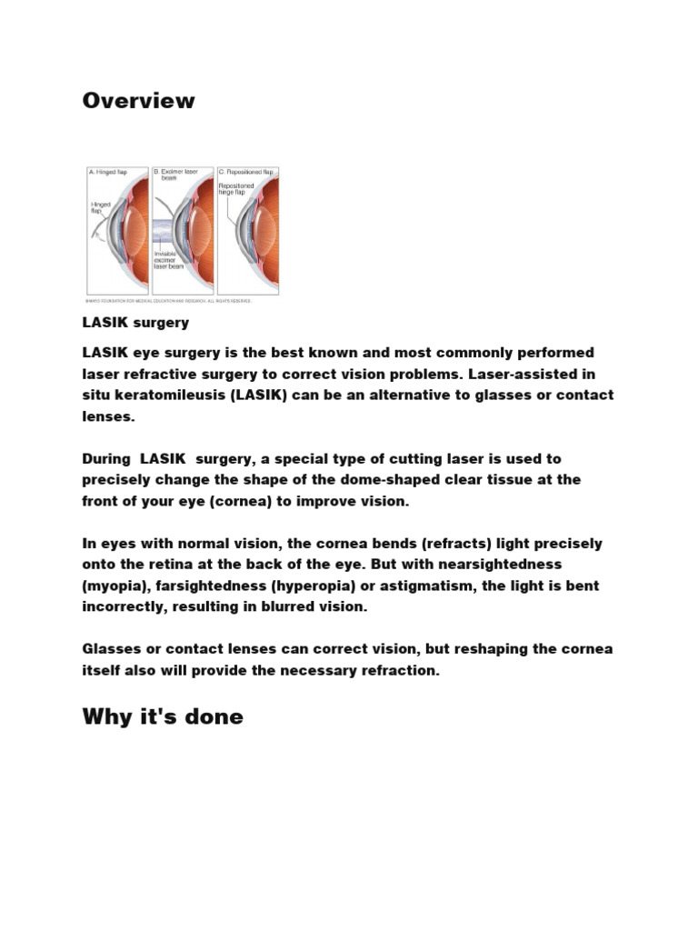 LASIK surgery | PDF | Myopia | Cornea